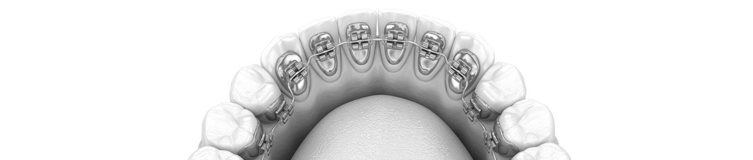 WIN Lingual Braces – Baker Street Dental