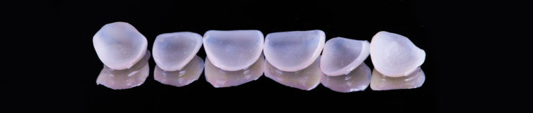 da Vinci Veneers – Baker Street Dental