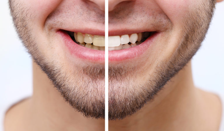 Tooth Shade Guide – Baker Street Dental