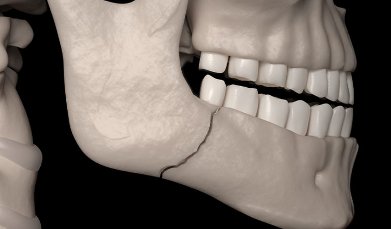 Jaw Injuries – Baker Street Dental