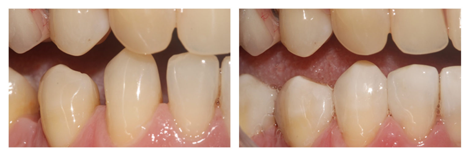 Diastemas Closure - Baker Street Dental