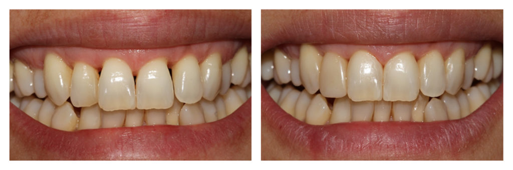 Black Triangle – Baker Street Dental