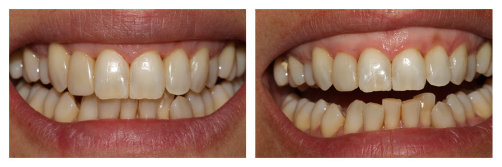 Black Triangle – Baker Street Dental