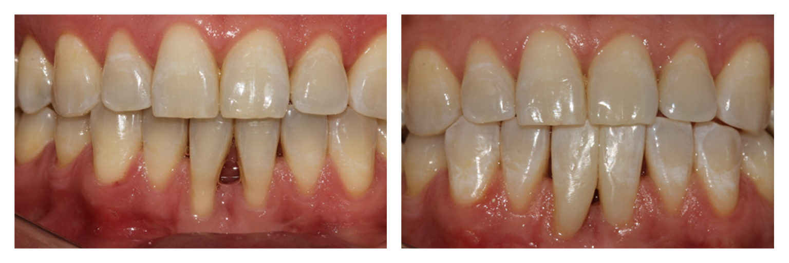 Black Triangle – Baker Street Dental