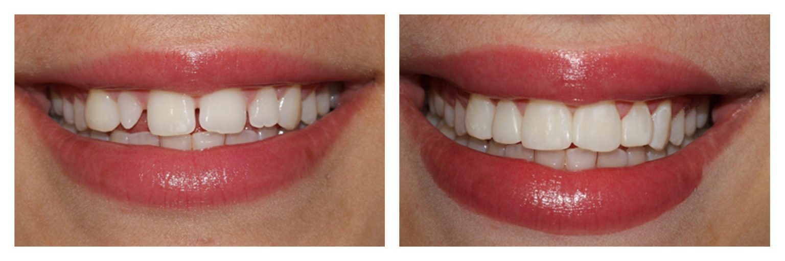 Dental Bonding – Baker Street Dental