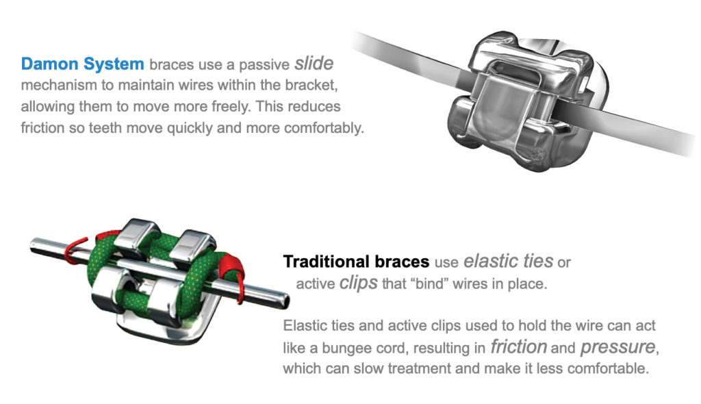 Self-ligating Braces – Baker Street Dental