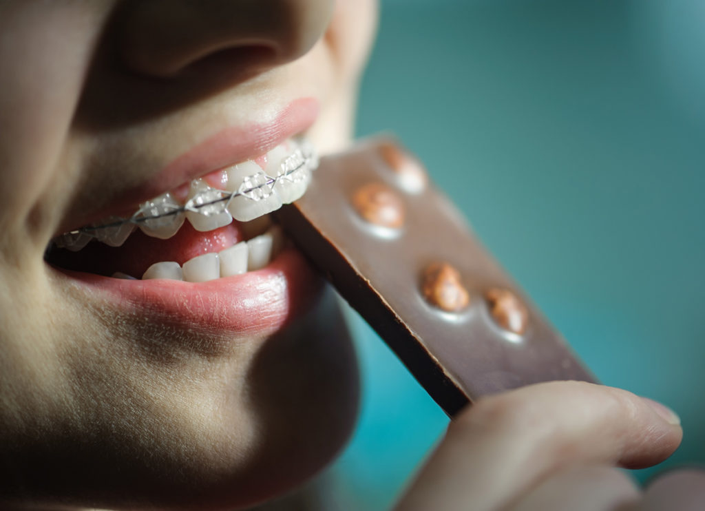 Clear Ceramic Braces – Baker Street Dental