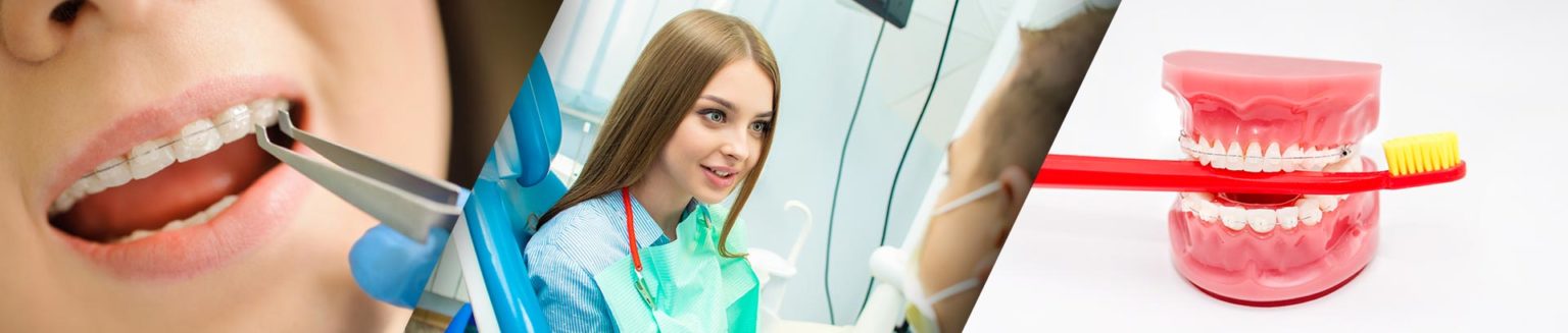 3M Clarity Advanced Ceramic Braces – Baker Street Dental