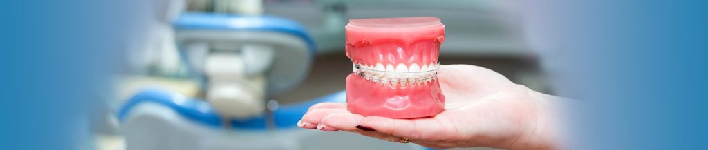 Clear Self-Ligating Braces – Baker Street Dental